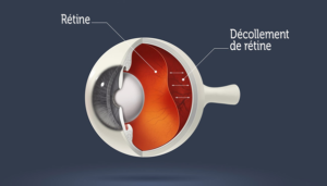 Décollement de rétine : causes, symptômes et traitements – Déficience ...